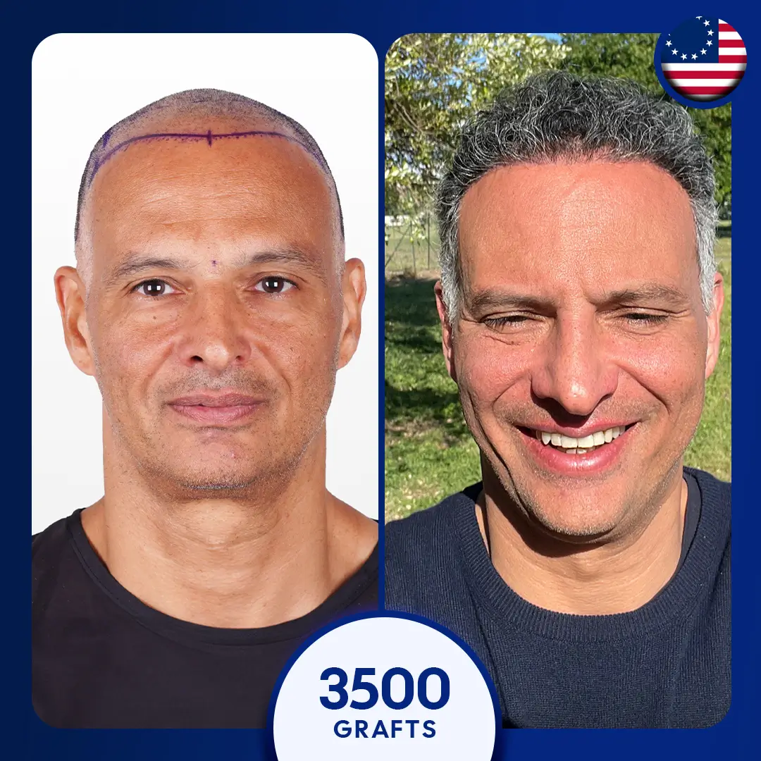 DHI vs FUE Hair Transplant - Vera Clinic