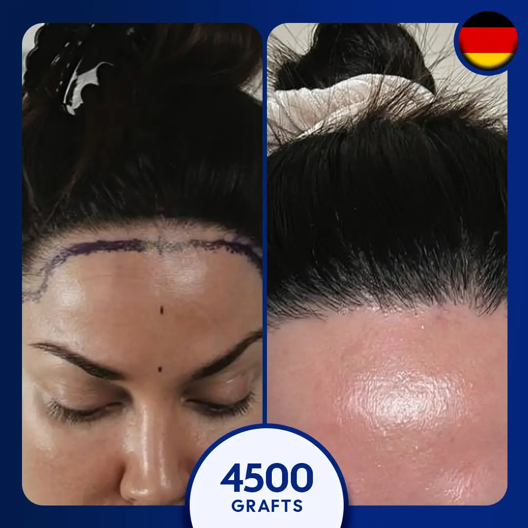 Female (Women) Hair Transplant in Turkey - Vera Clinic