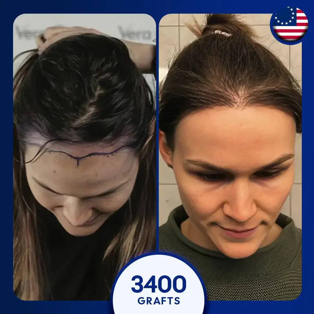 Female (Women) Hair Transplant in Turkey - Vera Clinic