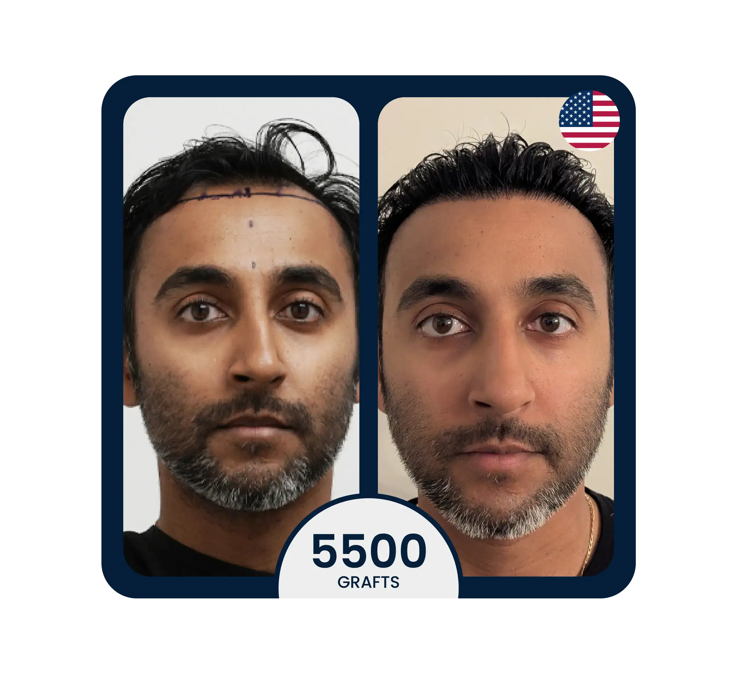 DHI Hair Transplant in Turkey - Vera Clinic