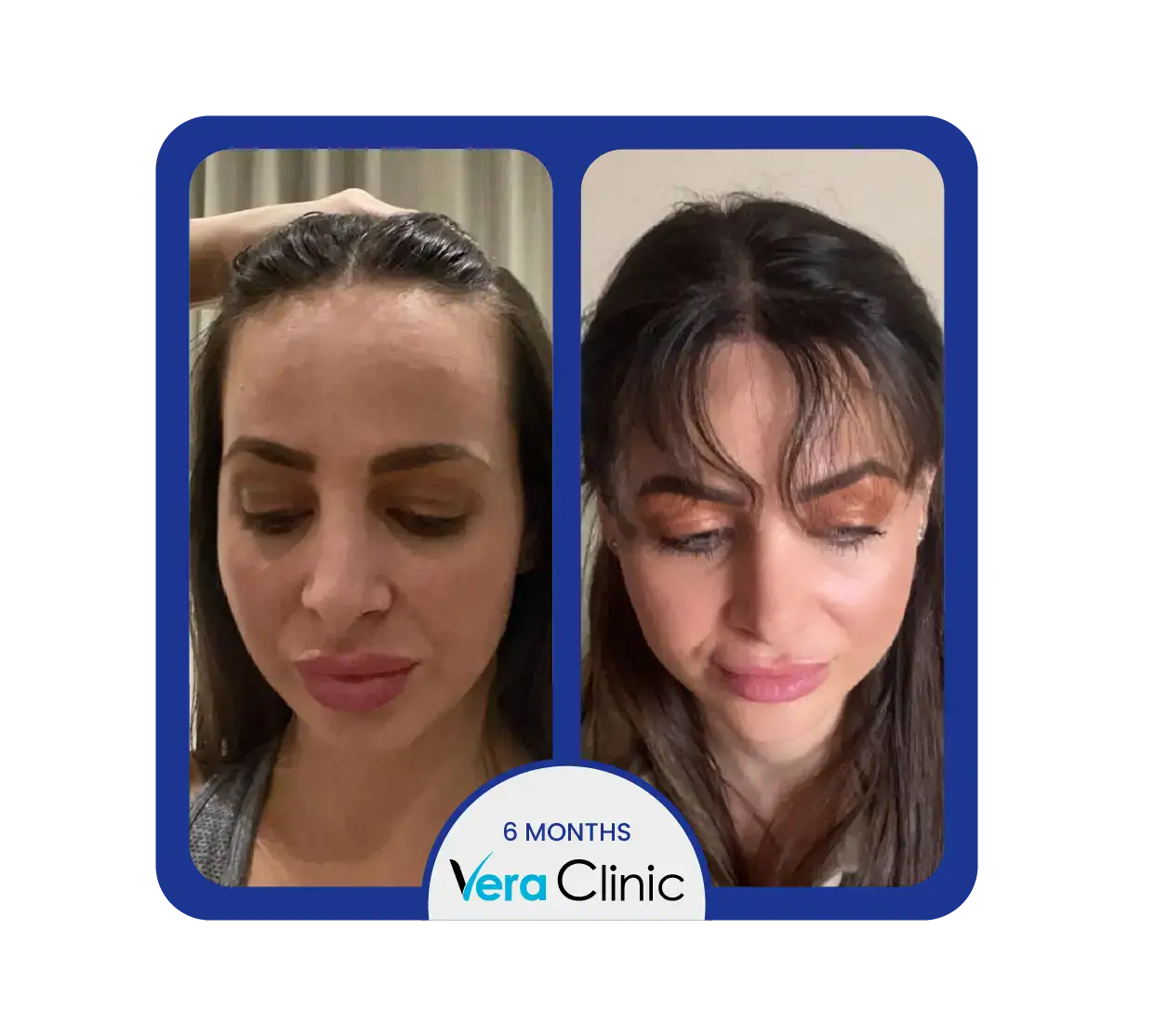 Turkey Hair Transplant Before and After - Vera Clinic