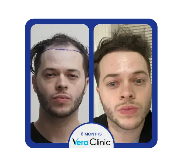 Turkey Hair Transplant Before and After - Vera Clinic