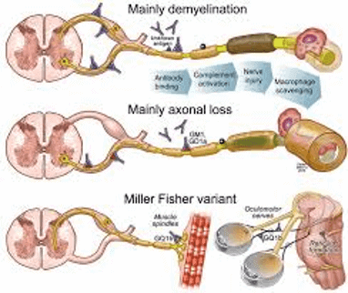 Catatan Koas2Doctor: Guillain Barre Syndrome Update - Koas2Doctor