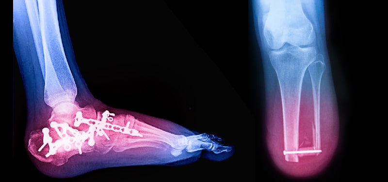 Below Knee Amputation Surgery – Recovery and Maintaining Mobility